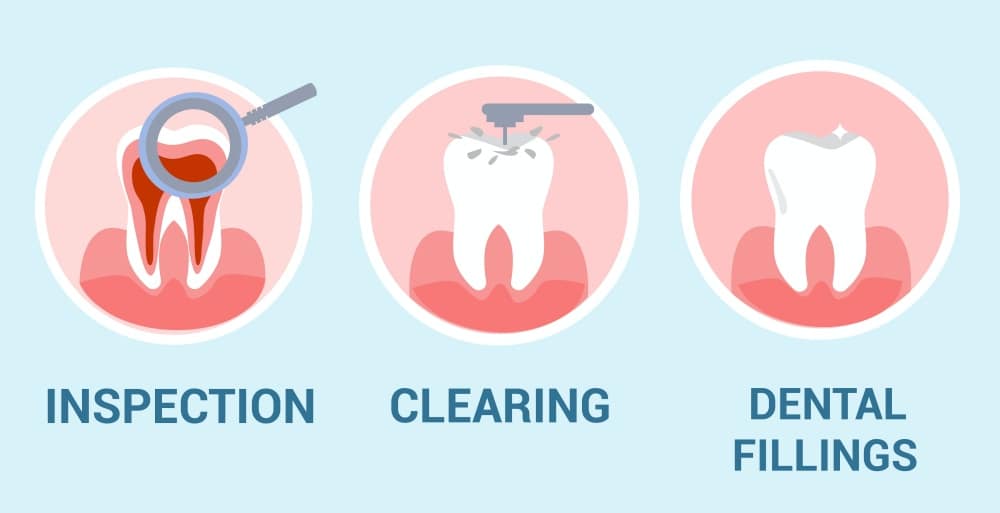 Dental Filling Procedure - Turkey - Amalgam, Composite Bonding