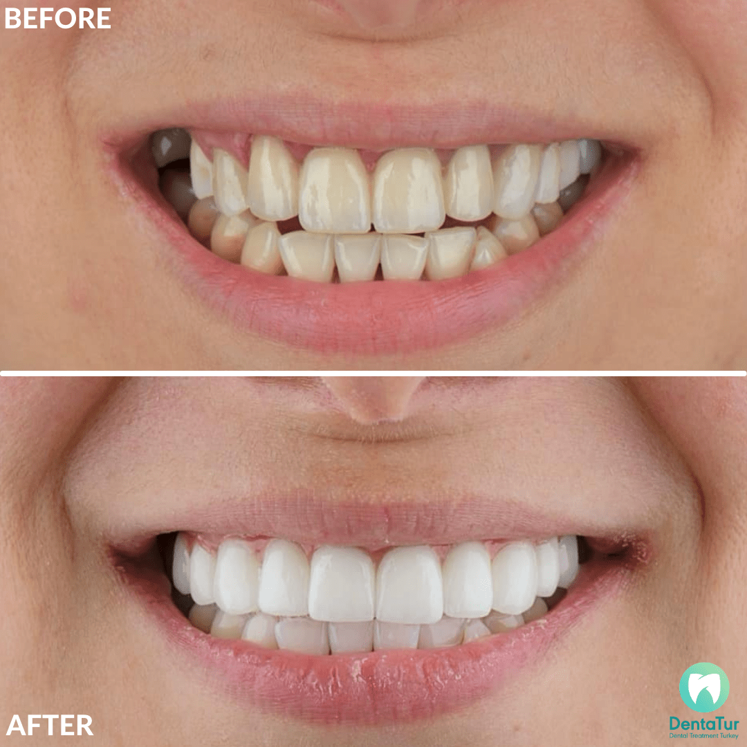 Dental Treatments in Turkey - Teeth Before and After Results
