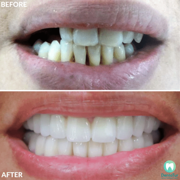 Dental Treatments in Turkey - Teeth Before and After Results