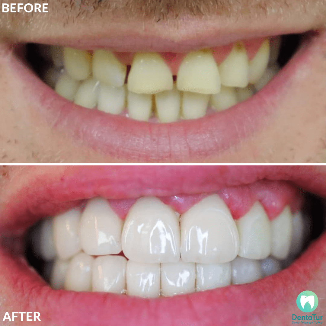 Zirconium Veneers In Turkey | Benefits - Dentatur
