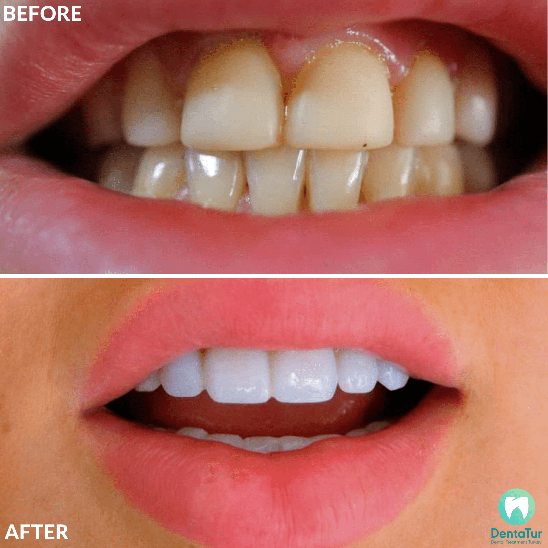 Dental Treatments in Turkey - Teeth Before and After Results