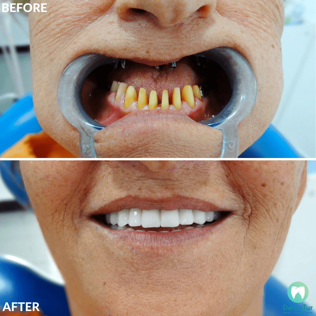 Dental Implants in Turkey: How to Choose the Best Clinic