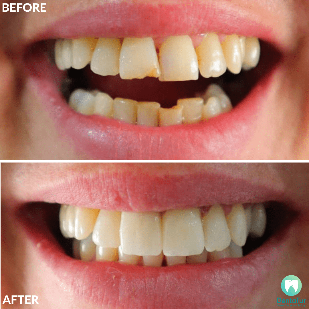 Dental Treatments in Turkey - Teeth Before and After Results