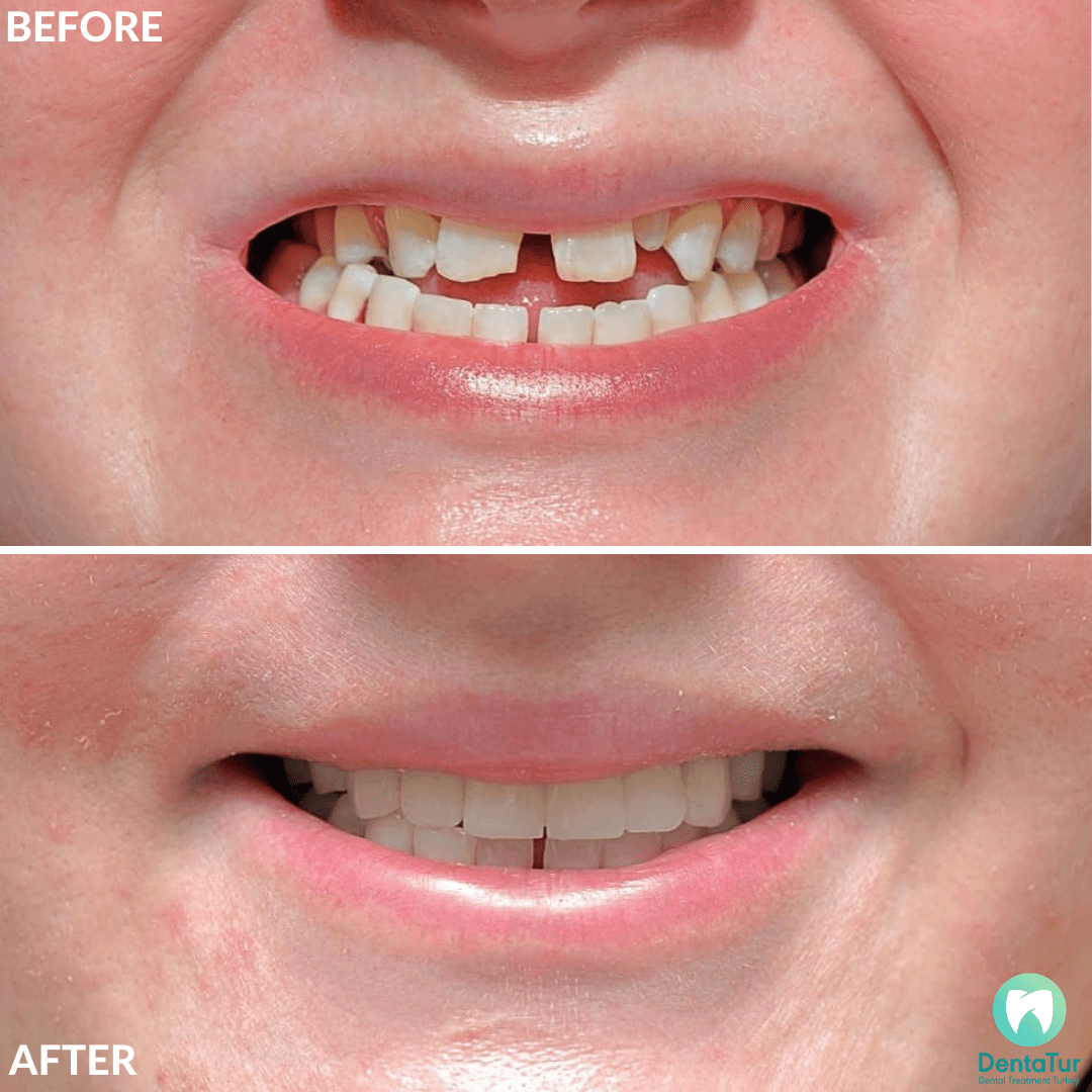Dental Treatments in Turkey - Teeth Before and After Results
