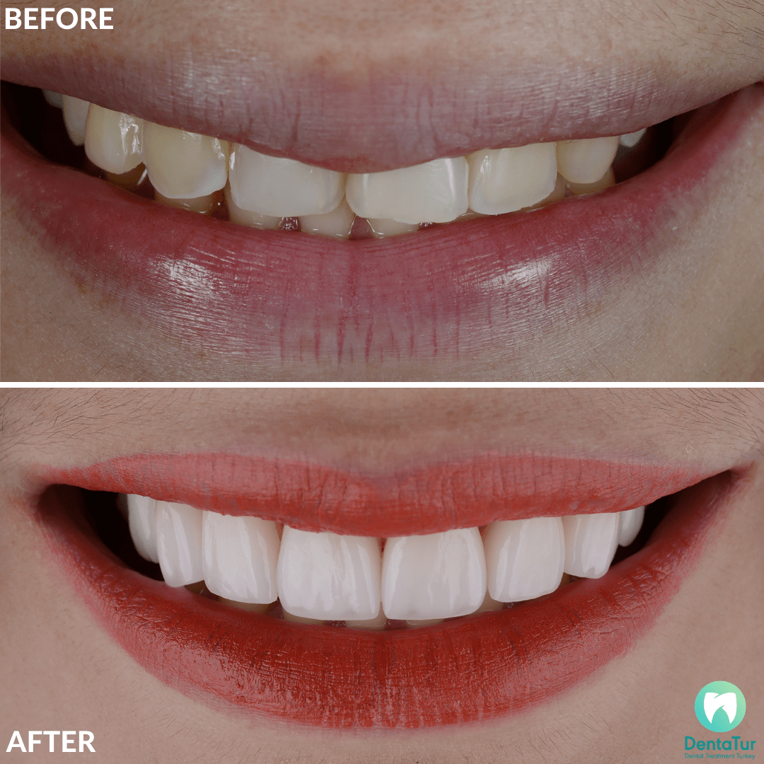 No-Prep Veneers Cost Turkey—Save more than 70% | Dentatur