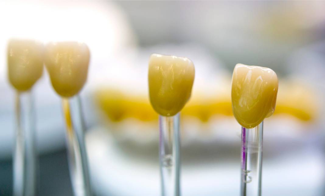 Dental veneers in Turkey | Price List | Dentatur