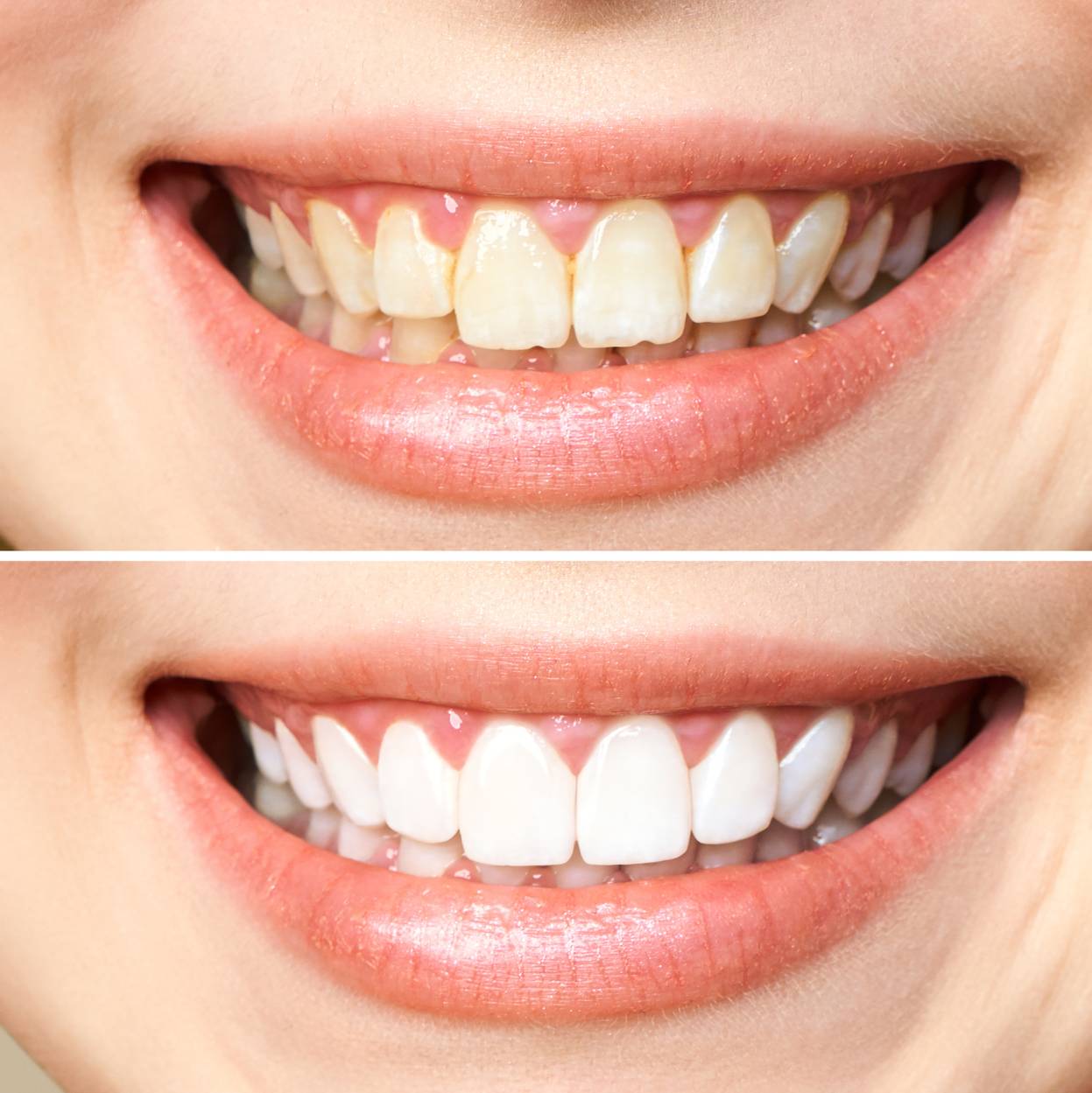 Where Do Celebs Get Their Teeth Done In Turkey