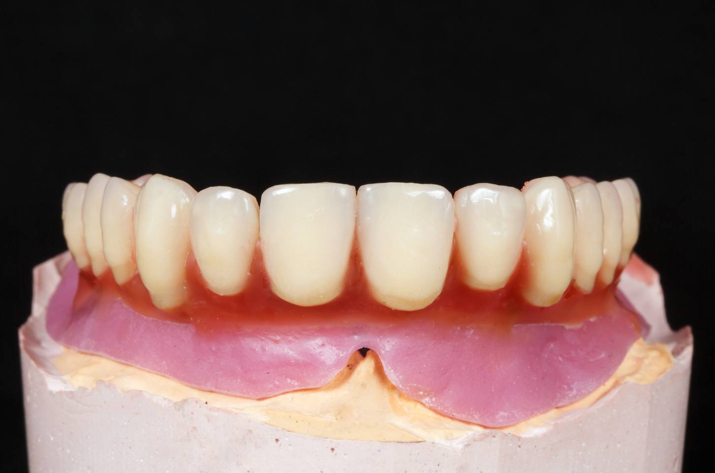 What are the benefits of veneers in Turkey? | Dentatur