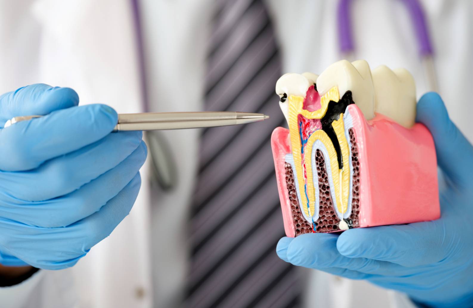 What is a tooth filling? | Dentatur