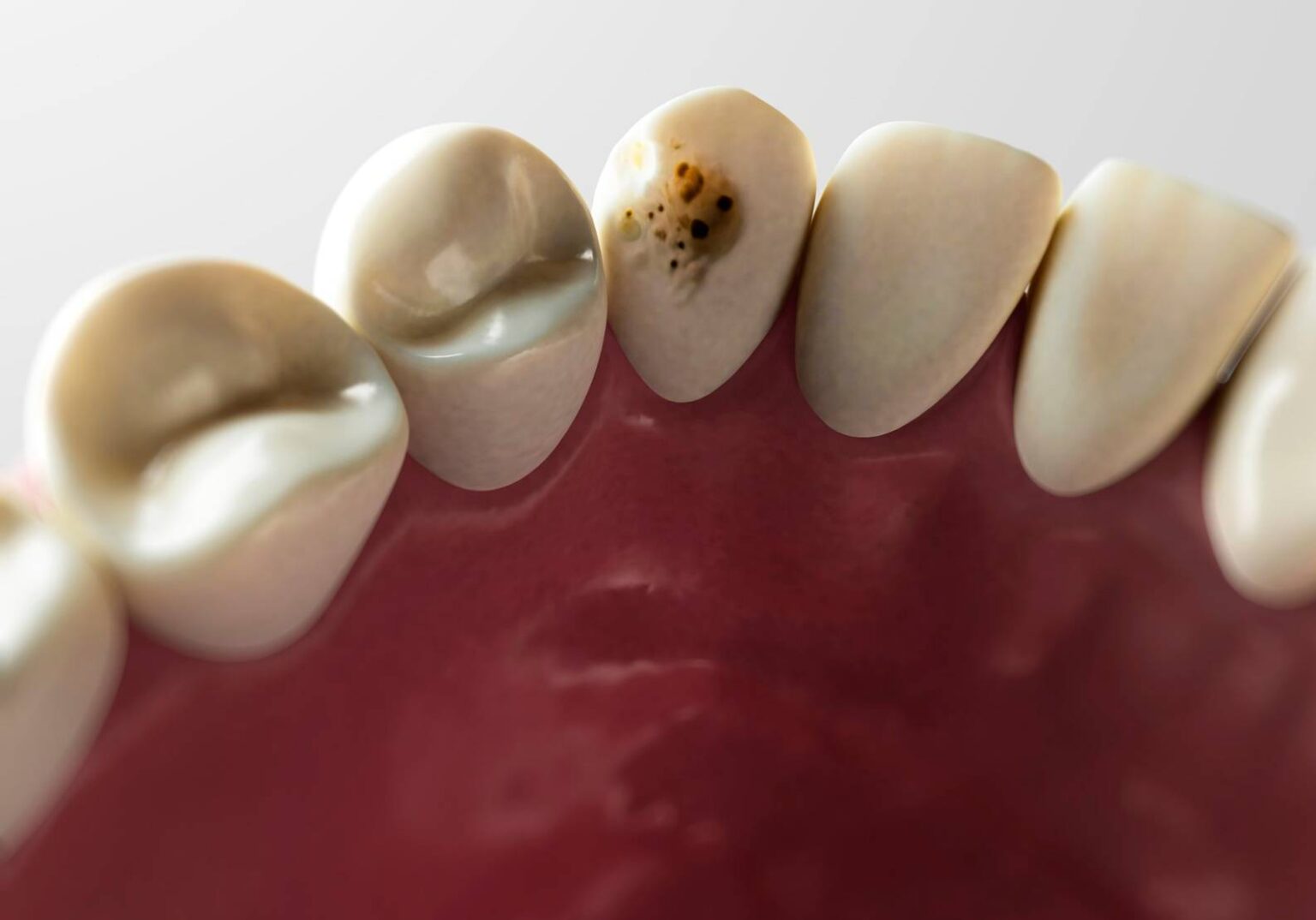 Can you get veneers if you have cavities? | Dentatur