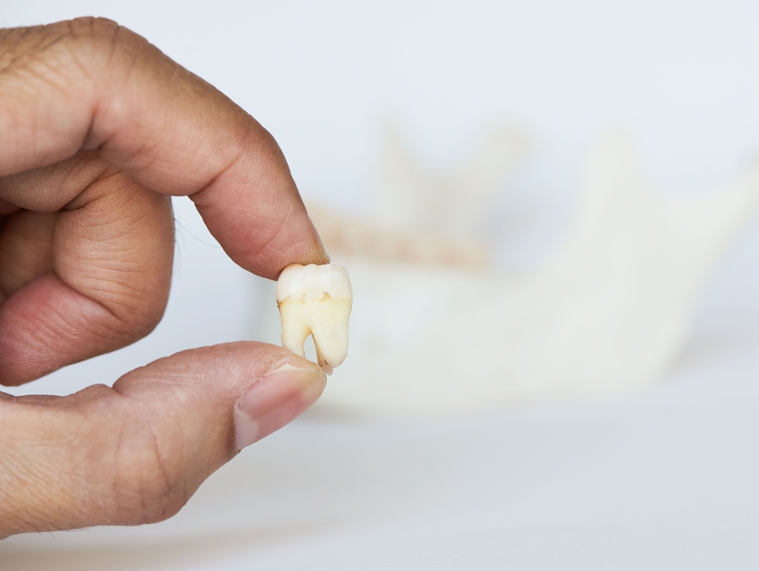 Teeth Surgery in Turkey