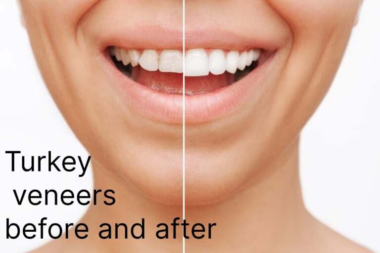 Turkey Veneers Before and After | Dentatur