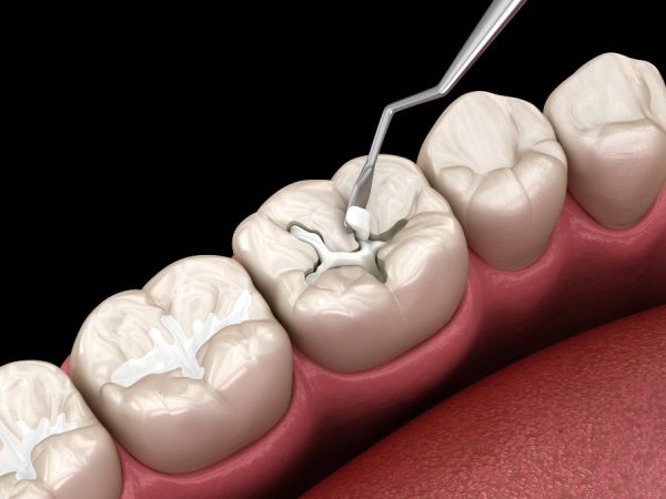 Cost of Tooth Filling in the UK | Private Prices Explained